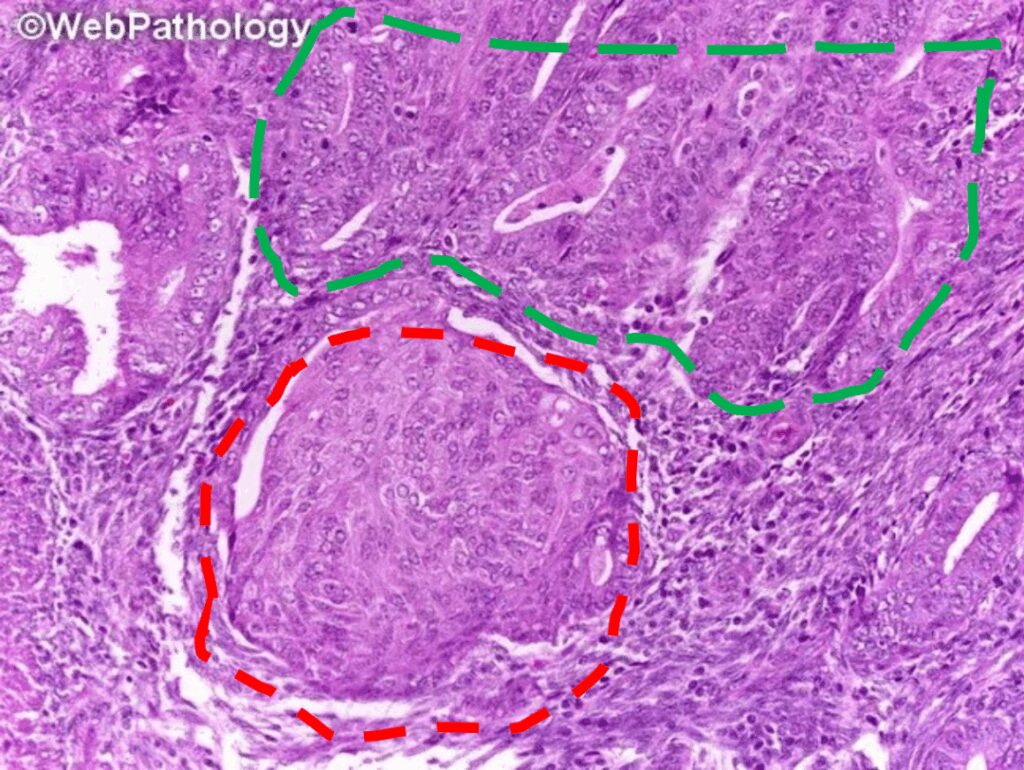 子宫内膜癌前病变(AH/EIN)诊断：病理特征与生物标志物应用解析 - MedFind