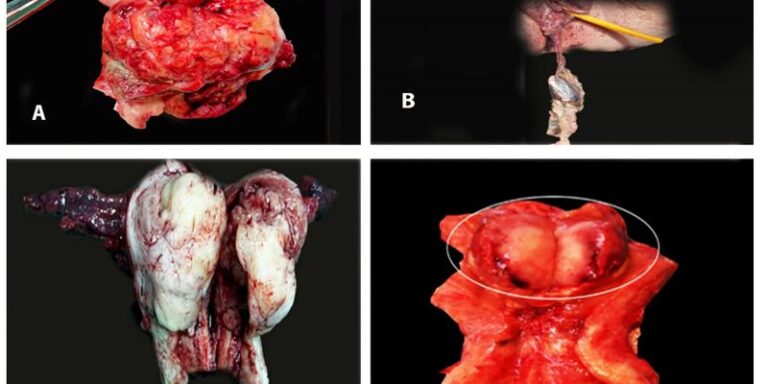 卵巢成年型粒层细胞瘤：深度解析临床特征、病理诊断与FOXL2基因突变 - MedFind