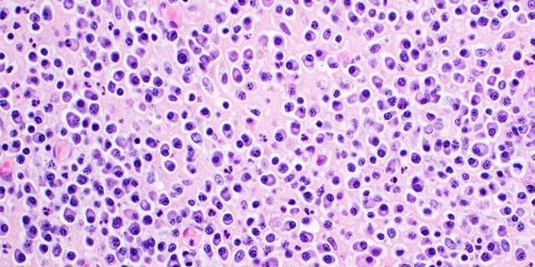 Telisotuzumab Vedotin（Emrelis）在c-MET过表达非小细胞肺癌中疗效显著 - MedFind