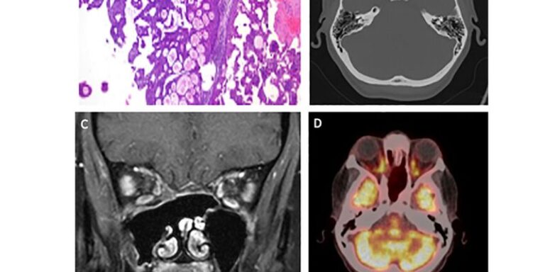 新型靶向药TQB2102：HER2-low乳腺癌治疗新突破，临床试验揭示显著疗效与良好耐受性 - MedFind